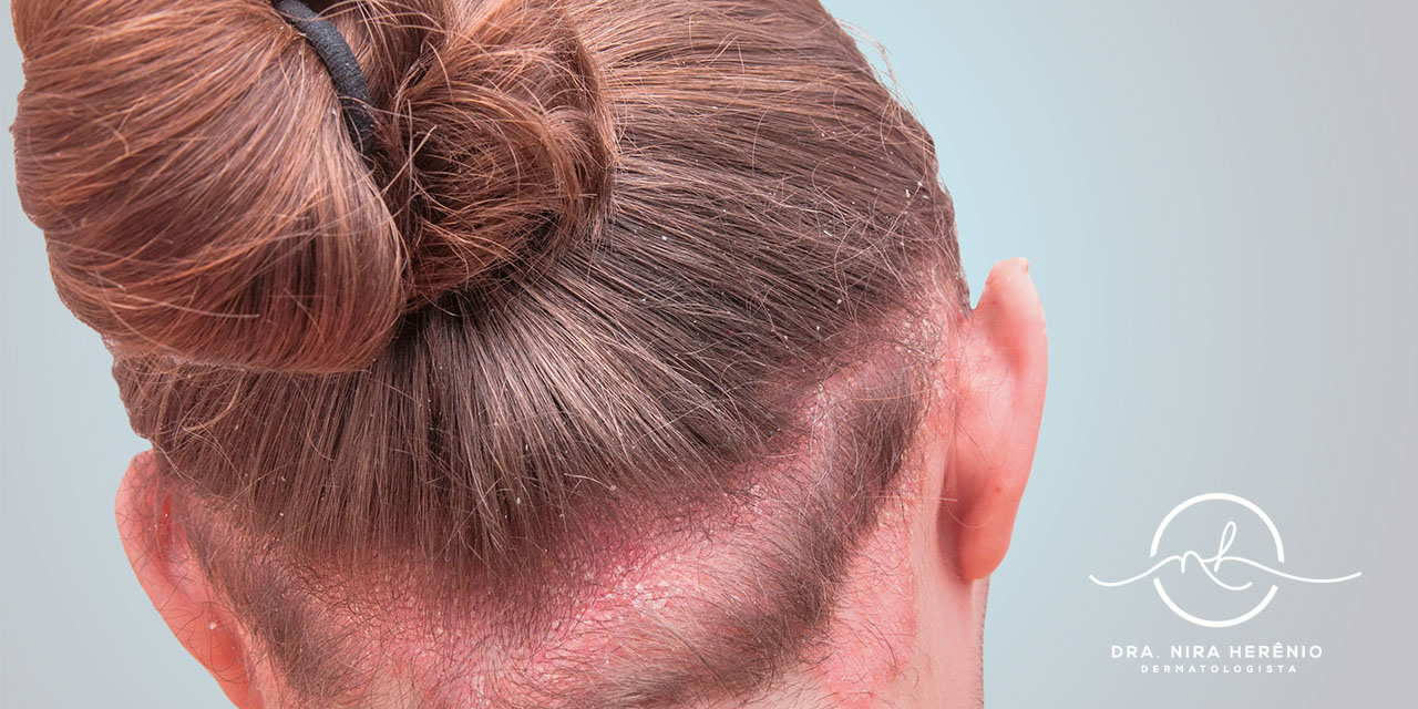 Dermatite Seborréica | Dra Nira Herênio Dermatologista Imperatriz